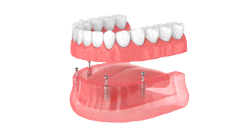Is Getting an Implant Denture Painful? | Dentistry in Wilkes-Barre