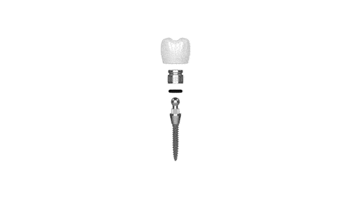 What is a Mini Dental Implant? | Dental Implants in Wilkes-Barre
